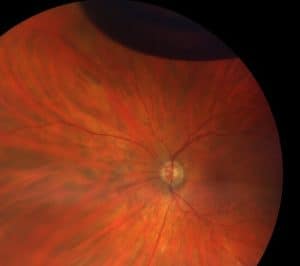 Photo Essay and A Brief Report on New Rhegmatogenous Retinal Detachment ...