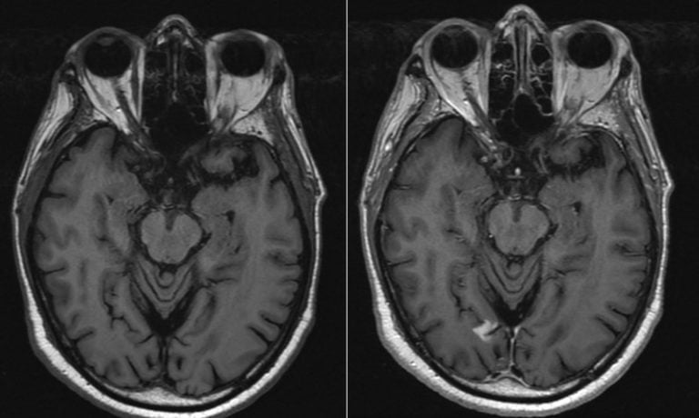 Asymptomatic Occipital Stroke Uncovered During Work-up For Optic ...