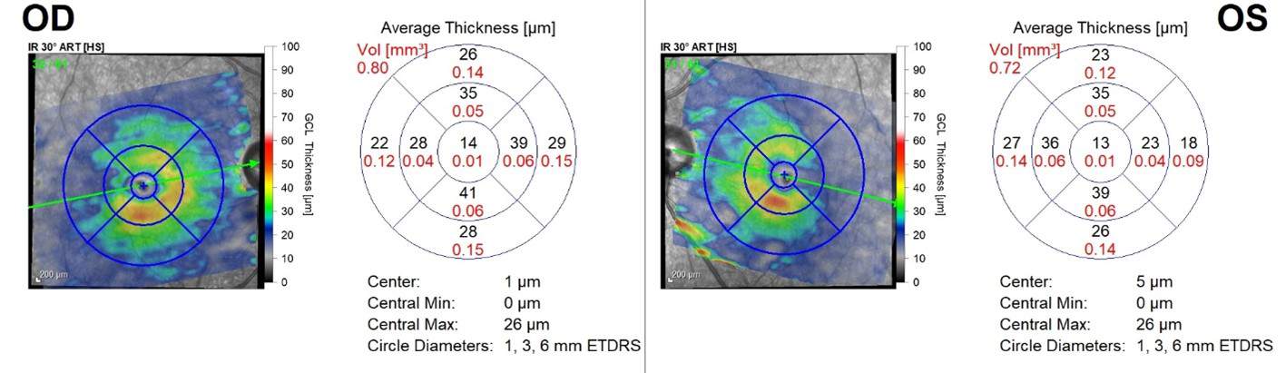 Asymptomatic Occipital Stroke Uncovered During Work-up For Optic ...