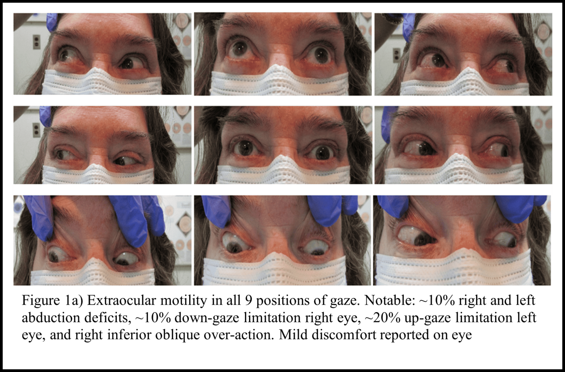 Active thyroid eye disease in the setting of Hashimoto's thyroiditis
