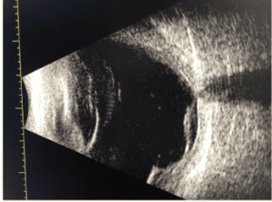 A Diagnostic Challenge of Scleromalacia Perforans - The Journal of ...