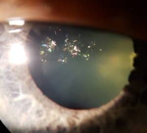 PHOTO ESSAY: Unilateral Christmas Tree Cataract - The Journal of ...
