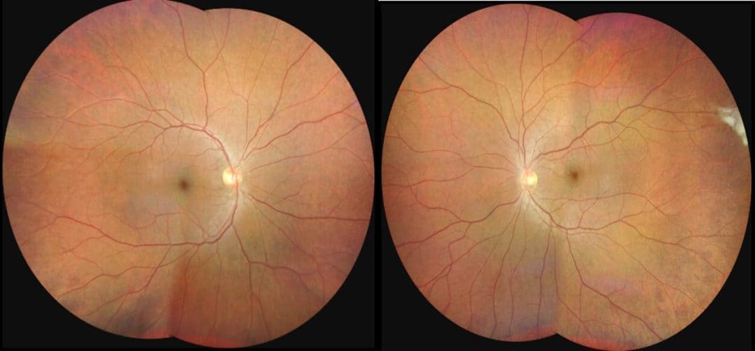 Sickle cell retinopathy: diagnosis, management, and treatment - The ...