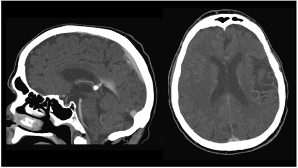Junctional Scotoma From Self-Inflicted Transnasal Penetrating Foreign ...