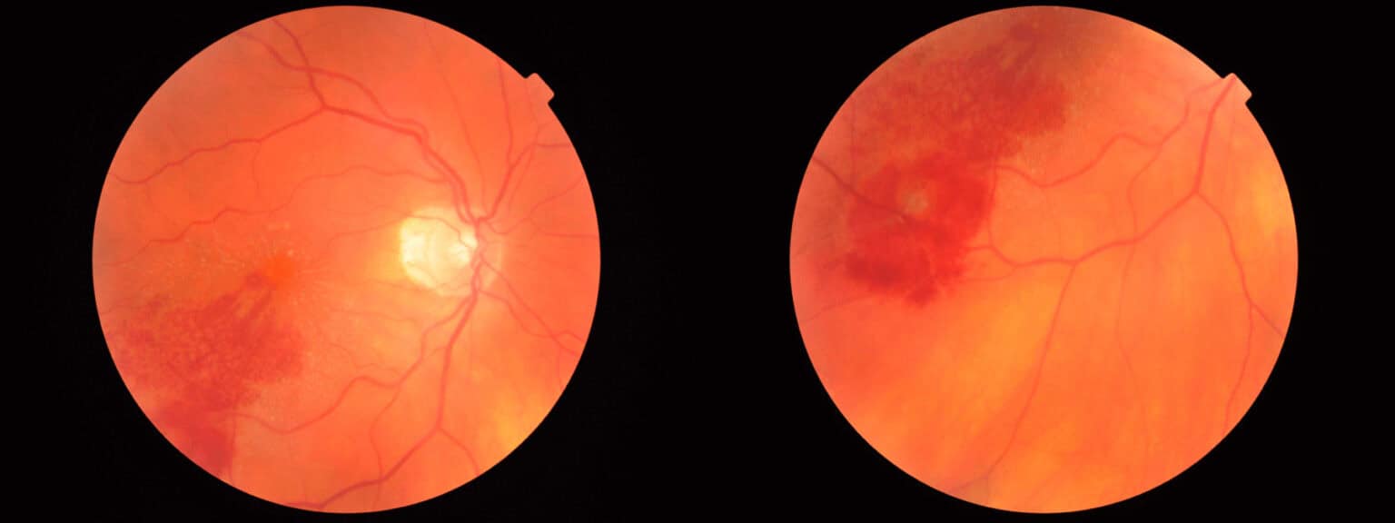 Management of a Retinal Arterial Macroaneurysm - The Journal of Medical ...