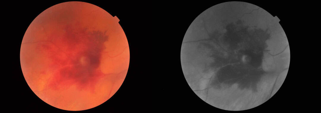 Management of a Retinal Arterial Macroaneurysm - The Journal of Medical ...