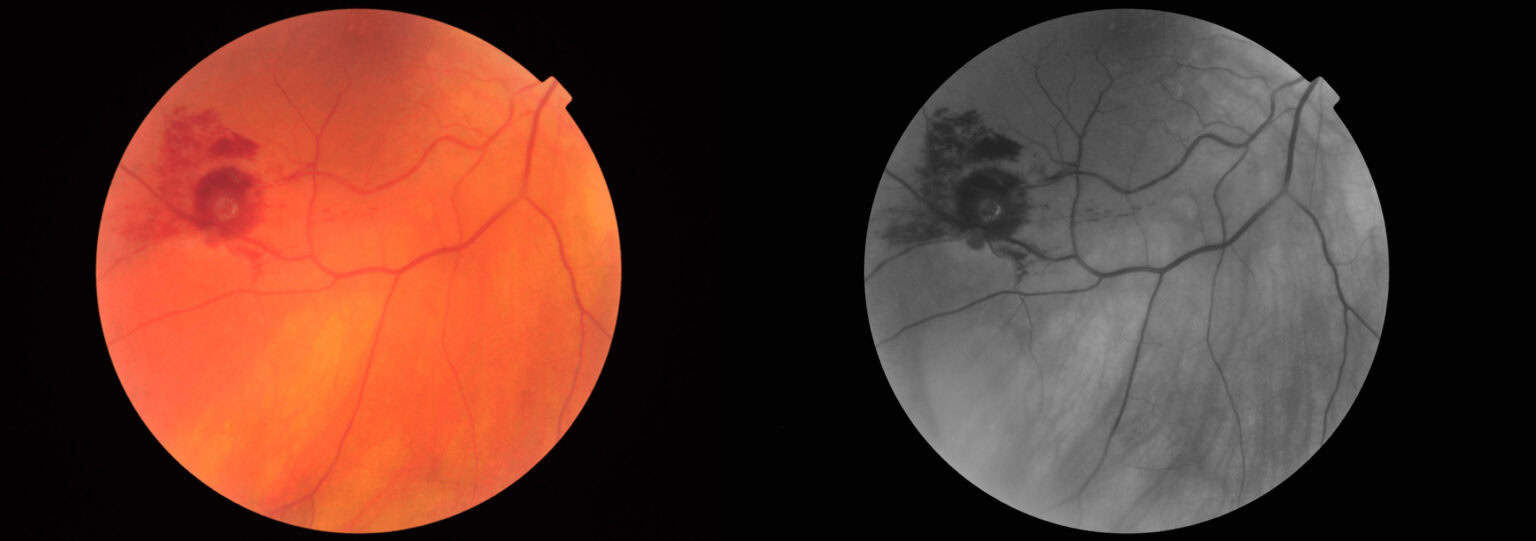 Management of a Retinal Arterial Macroaneurysm - The Journal of Medical ...