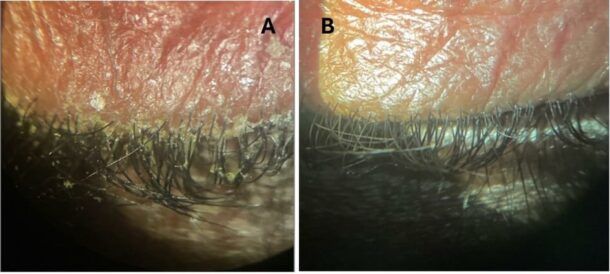 Traditional and Novel Treatment of Demodex Blepharitis - The Journal of ...