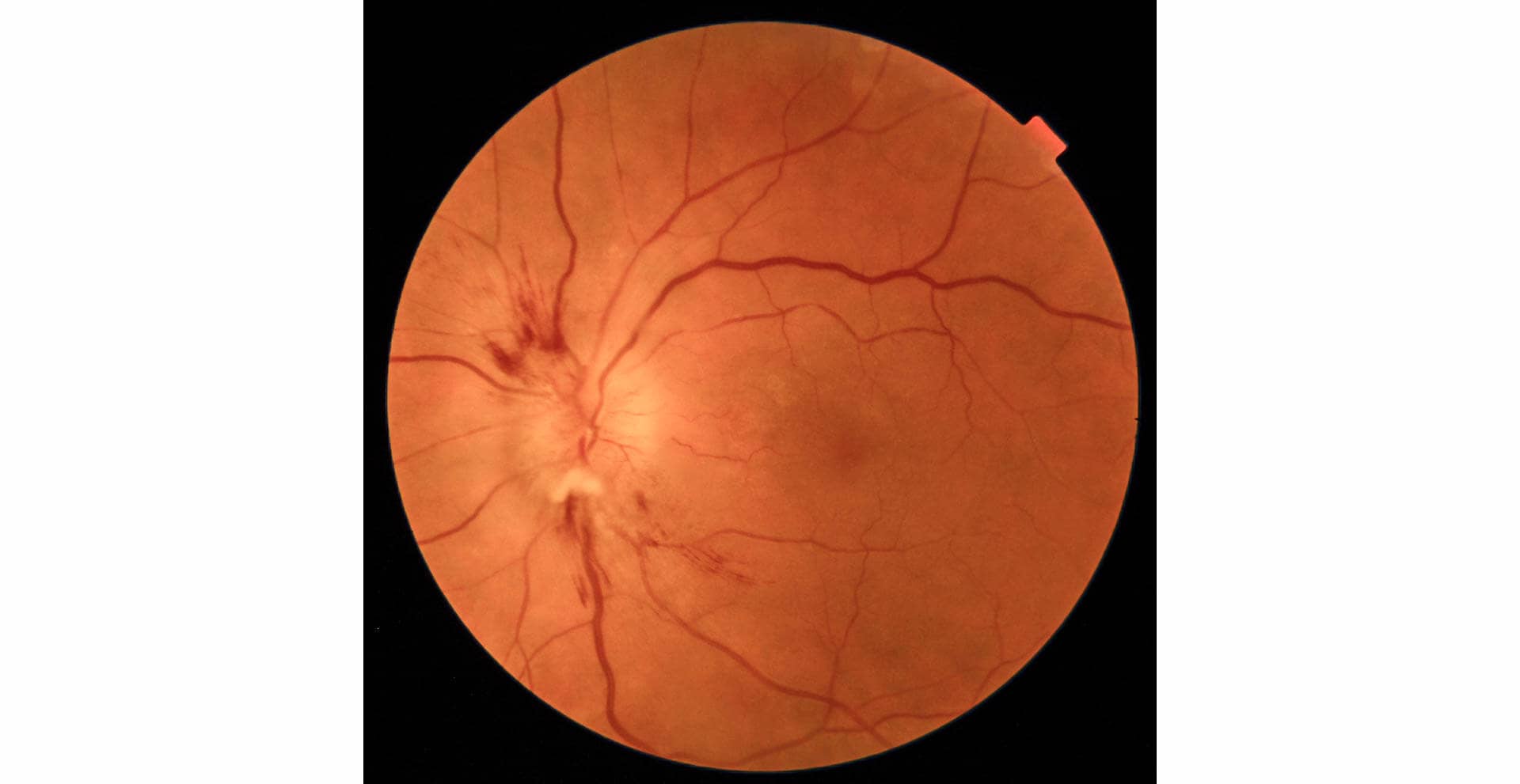 Overtreated Hypertension Results in Sequential Nonarteritic Ischemic ...