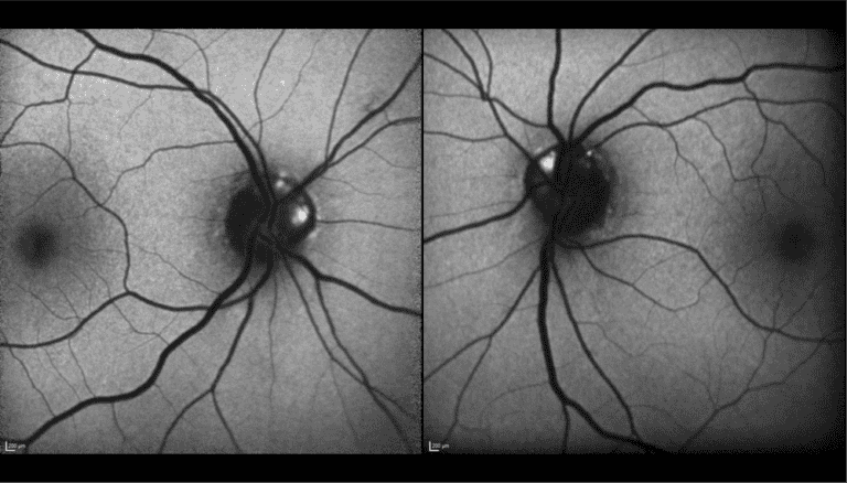 A Classic Neuro-Ophthalmic ODDity From a Modern Perspective - The ...