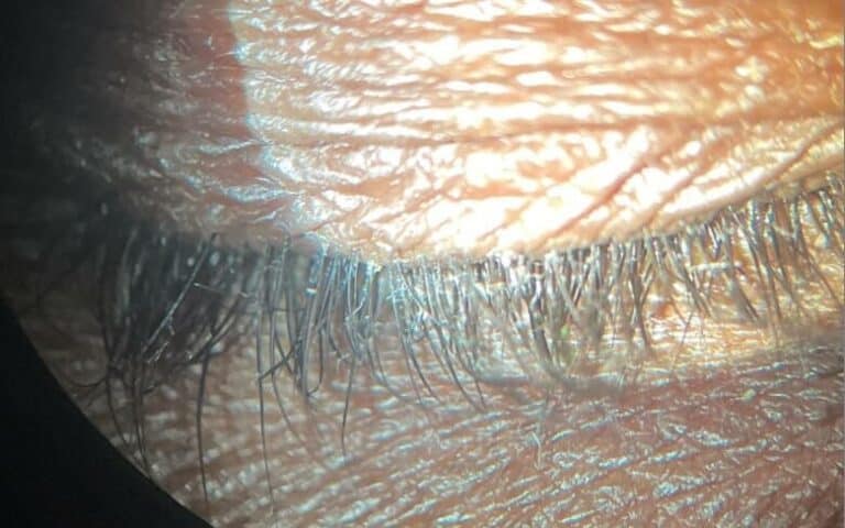 Traditional and Novel Treatment of Demodex Blepharitis - The Journal of ...