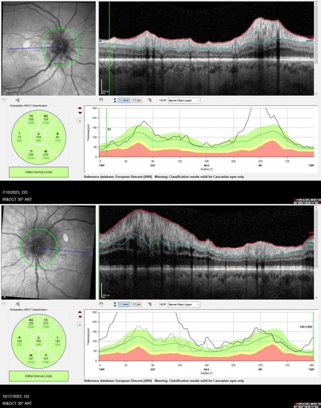 Overtreated Hypertension Results in Sequential Nonarteritic Ischemic ...