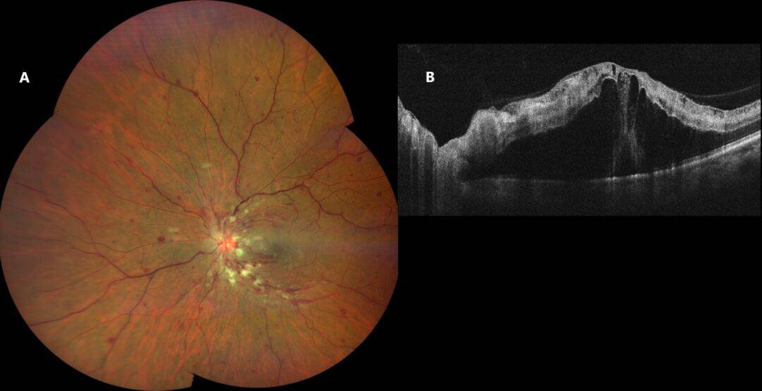 Assessing Risk of Neovascular Sequelae in Central Retinal Vein ...