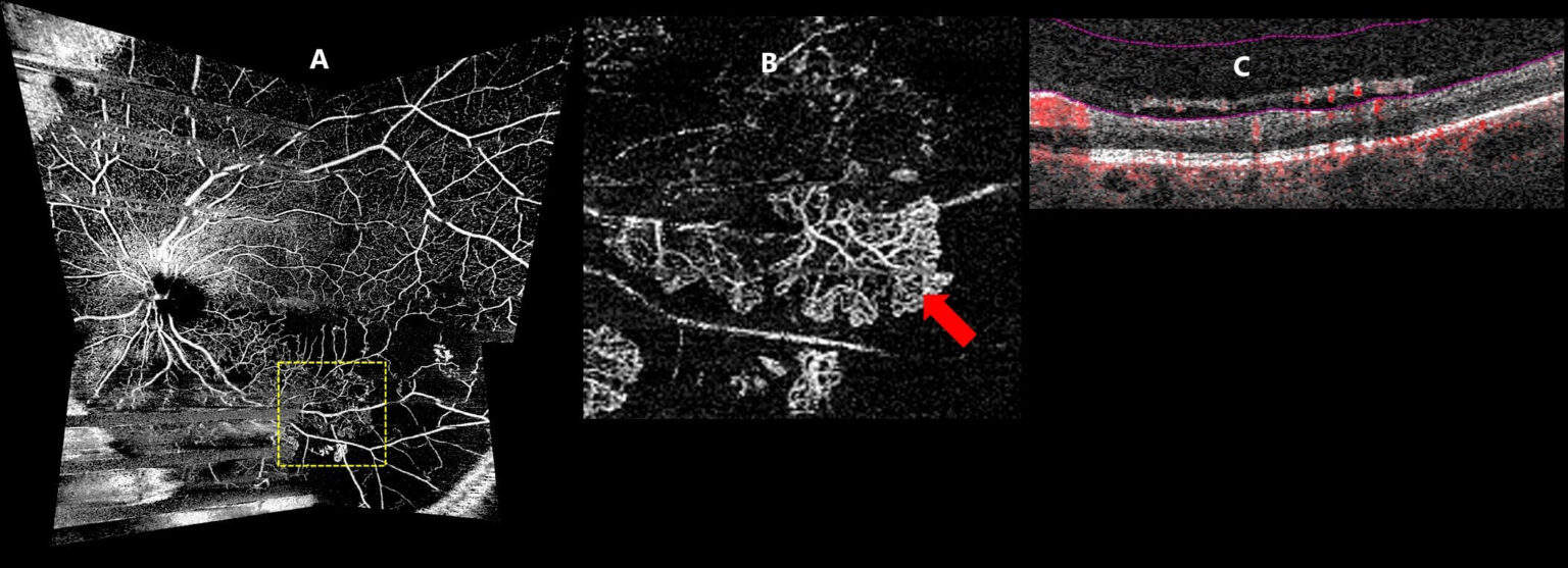 Assessing Risk of Neovascular Sequelae in Central Retinal Vein ...