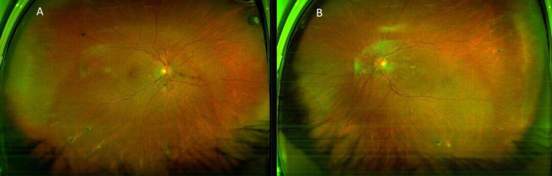 Pseudoxanthoma Elasticum and Angioid Streaks - The Journal of Medical ...