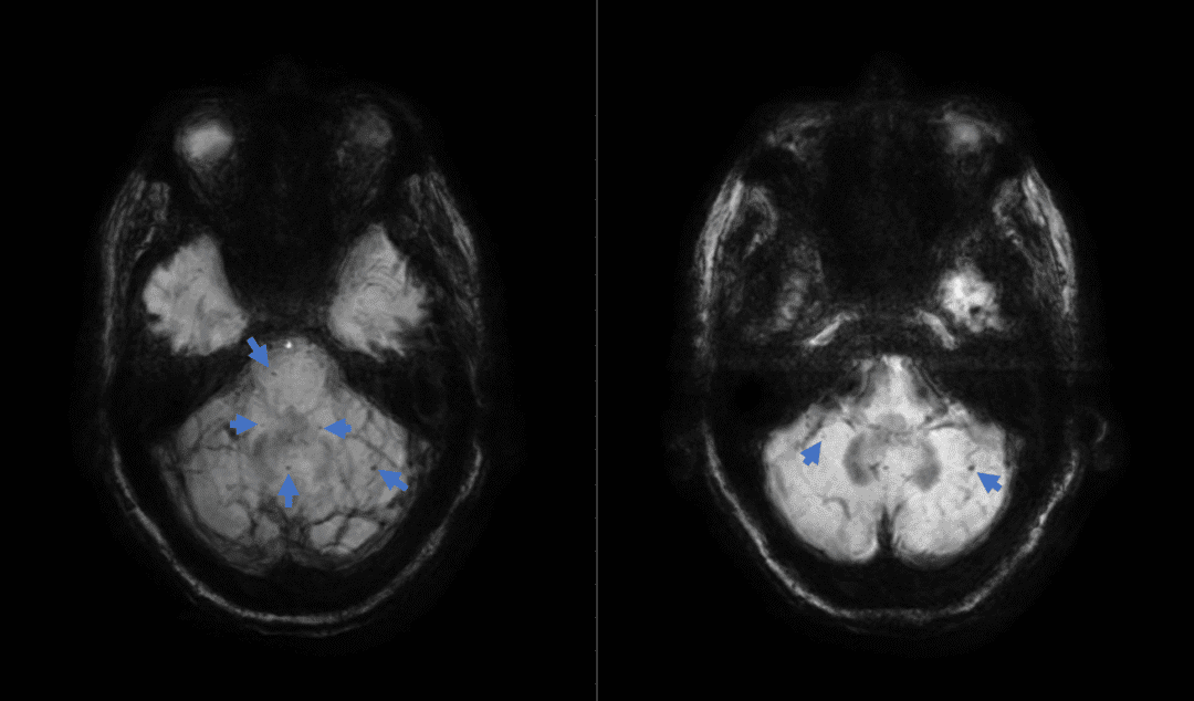 Ocular Tilt Reaction Associated with Infratentorial Microhemorrhages ...