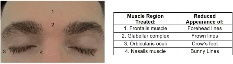 A Case Series of Ophthalmic Manifestations of Facial Botox Injections ...