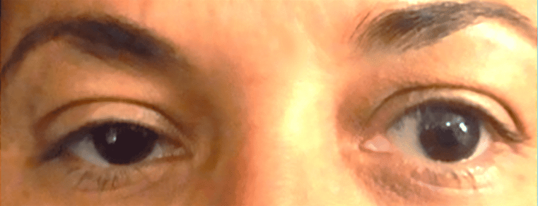 A Case Series of Ophthalmic Manifestations of Facial Botox Injections ...