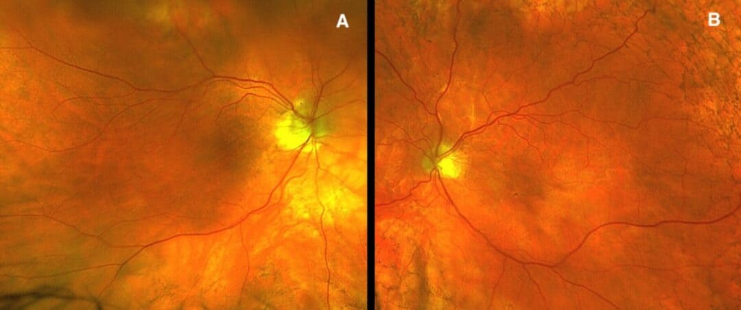 Navigating Choroidal Folds: A Comprehensive Approach for the Primary ...