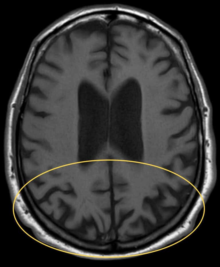 Diagnosis and Management of Posterior Cortical Atrophy from an Eye Care ...