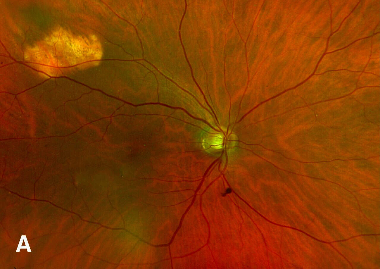 Photo Essay: Sclerochoroidal Calcifications - The Journal of Medical ...