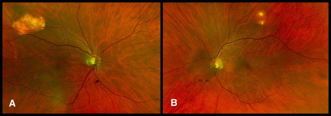 Photo Essay: Sclerochoroidal Calcifications - The Journal of Medical ...